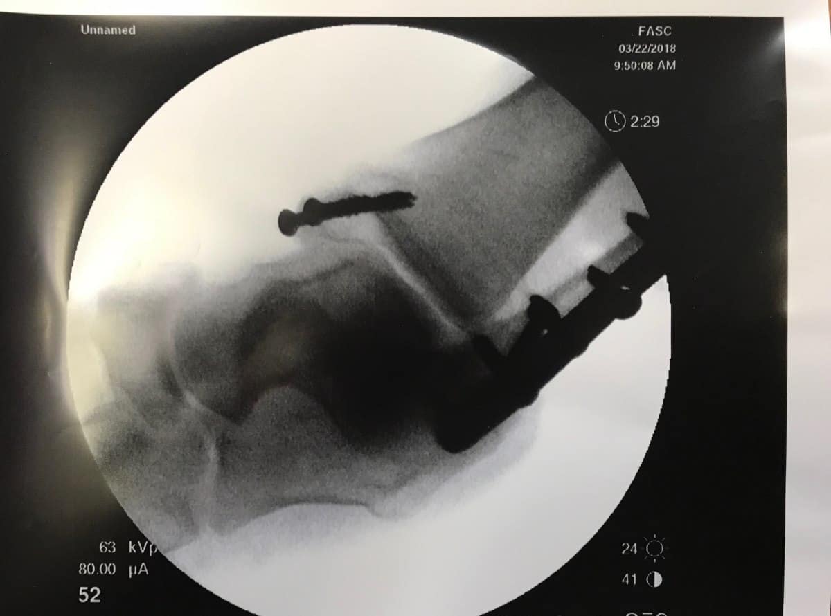 How A Broken Ankle Actually Brought Us Closer Together » Read Now!